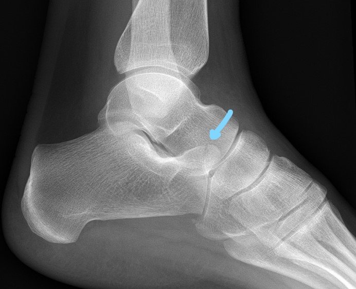 Anterior Calcaneus Fracture