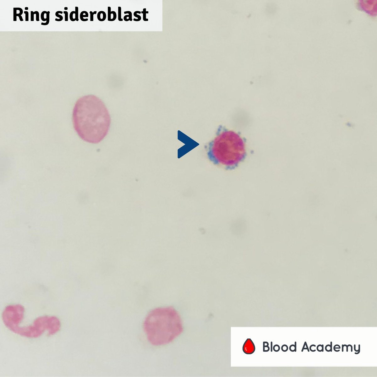 Prussian Blue Stain Sideroblastic Anemia