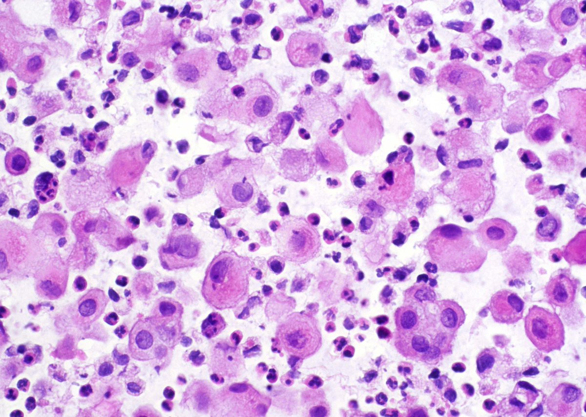 Prognosis For Primary Peritoneal Cancer Stage 3