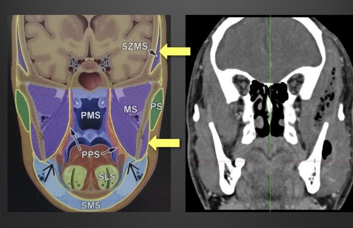 Masticator Space Infection