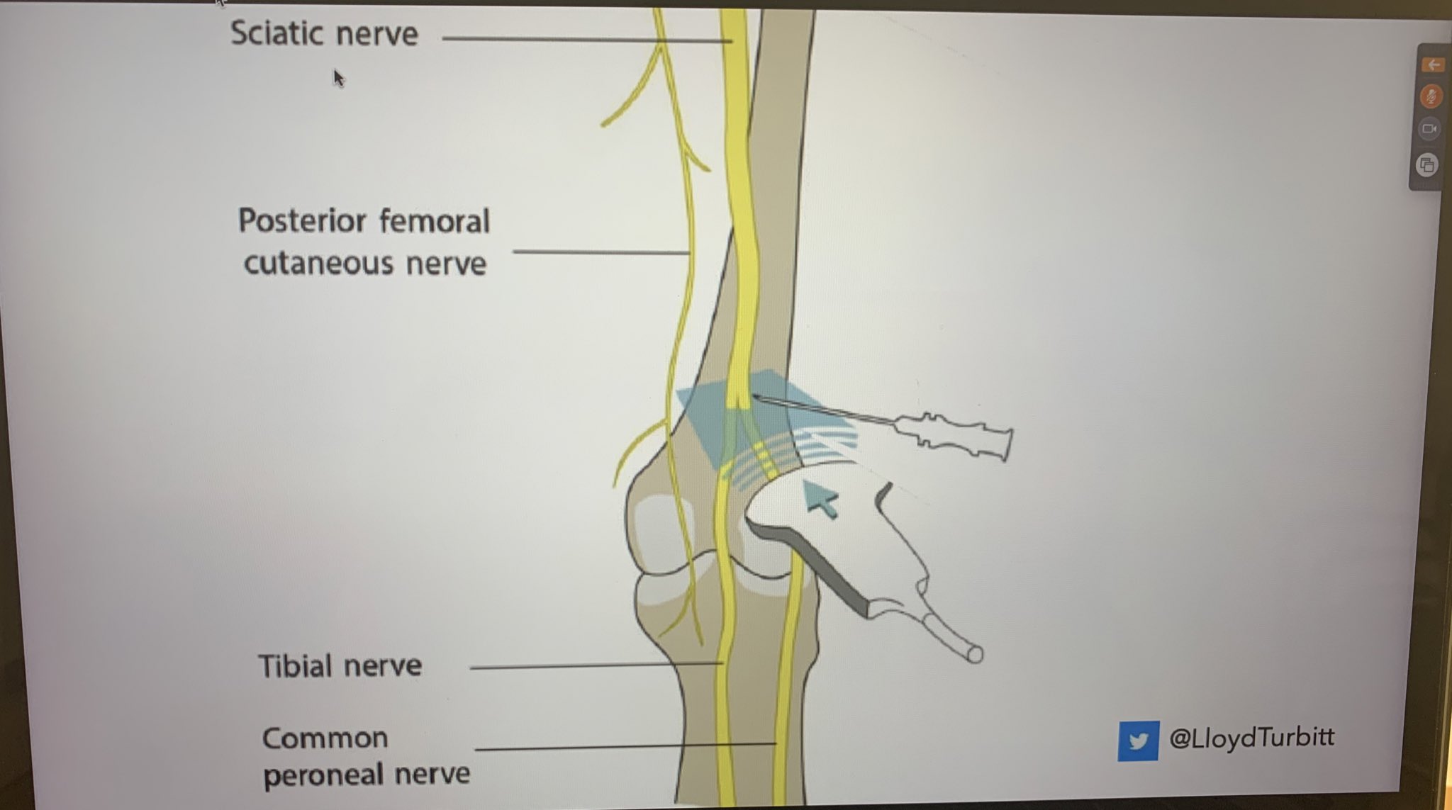 Femoral And Sciatic Nerve