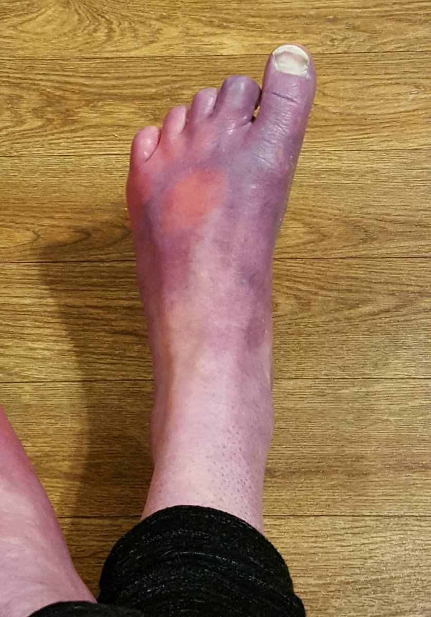 Acrodermatitis Chronica Atrophicans