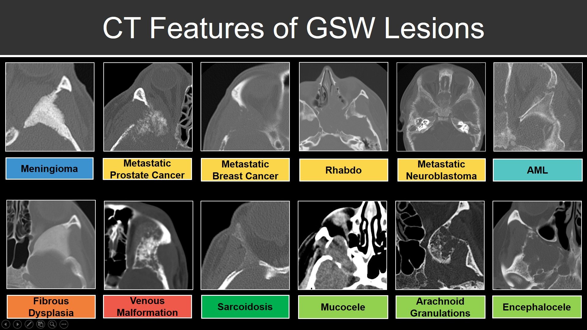 Sphenoid Bone Dysplasia