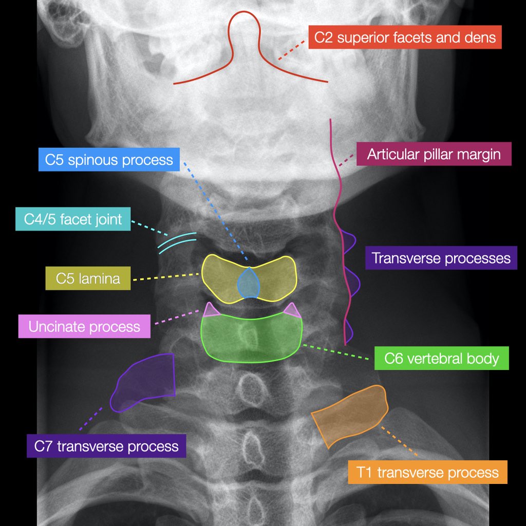 Uncinate Process Vertebra