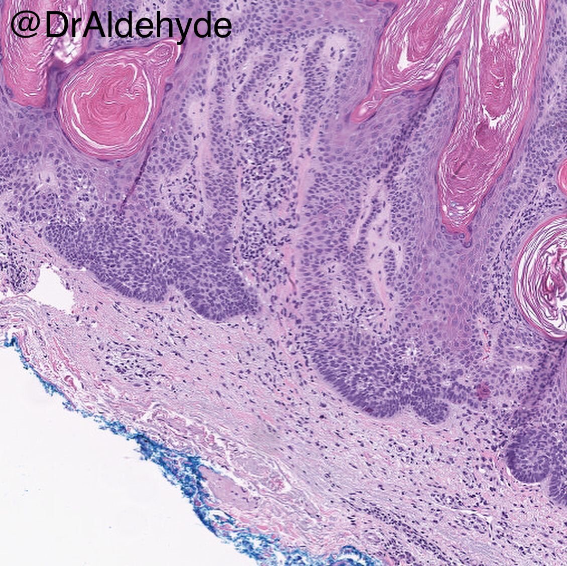 Irritated Seborrheic Keratosis Histology