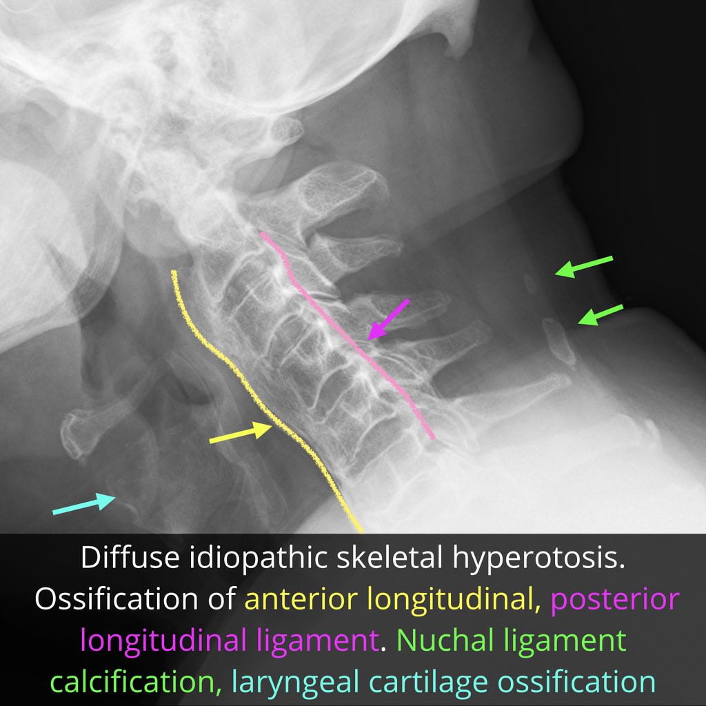 Nuchal Ligament Calcification