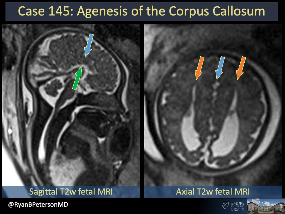 Emory Radiology COTD #145 Hx: Abnormality on fetal USG (*from my case ...