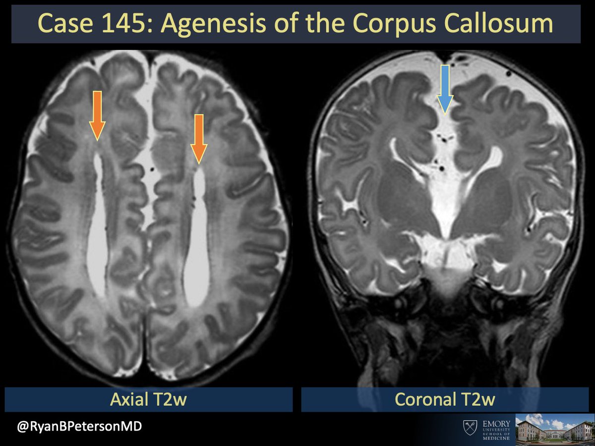 Emory Radiology COTD #145 Hx: Abnormality on fetal USG (*from my case ...