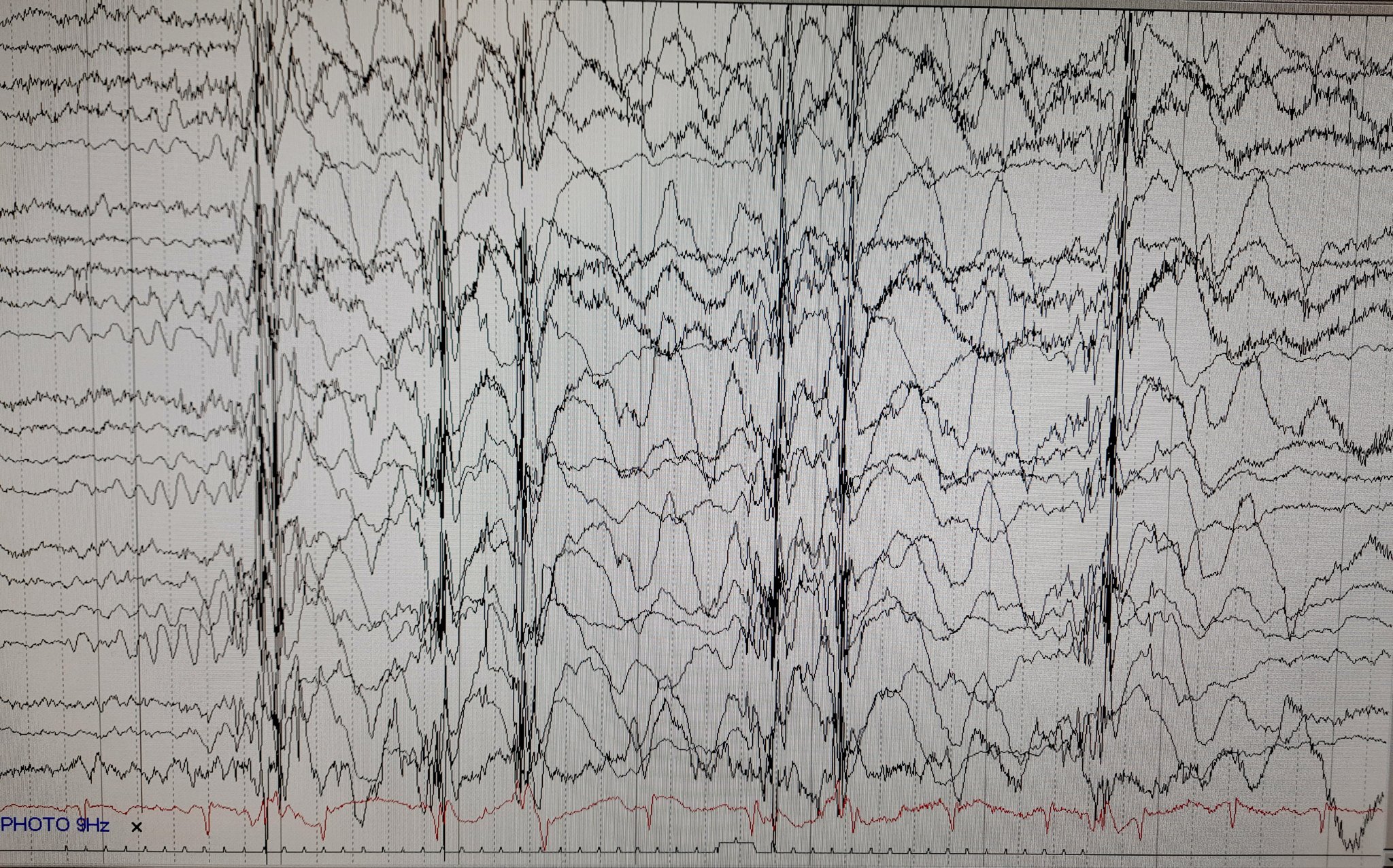 Myoclonic Seizure Eeg