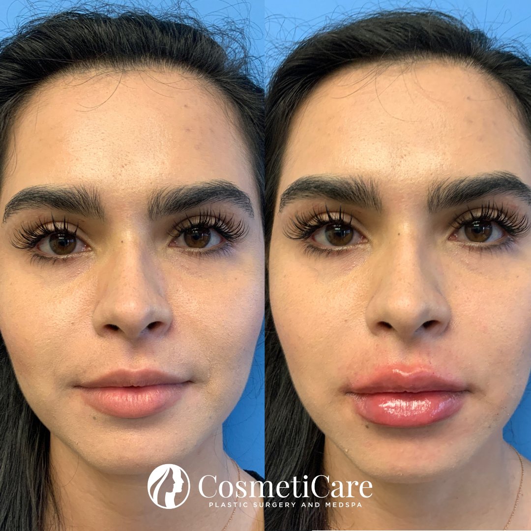 Lip Injections Before And After Celebrities