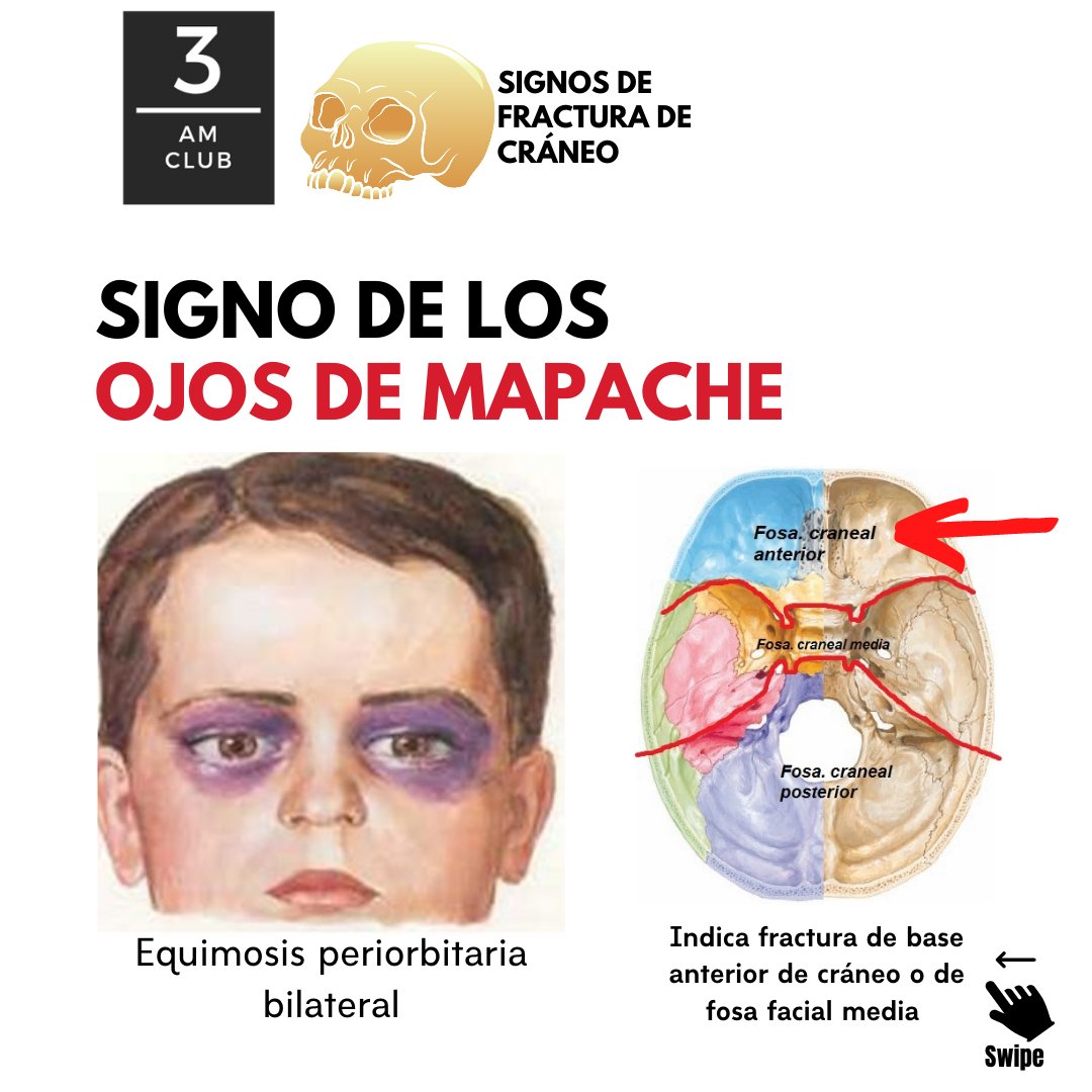 Equimosis Periorbitaria