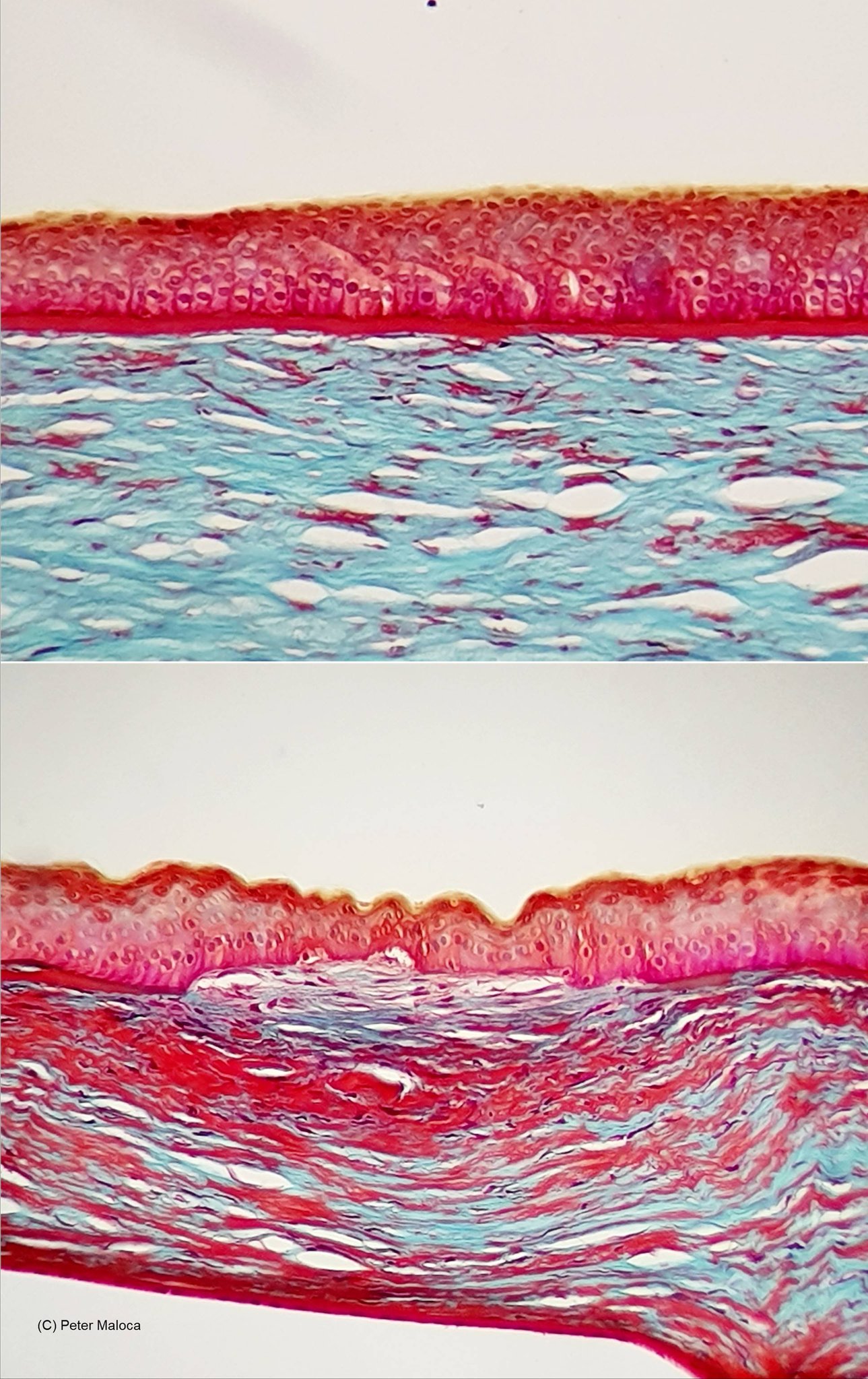 Keratoconus Histology