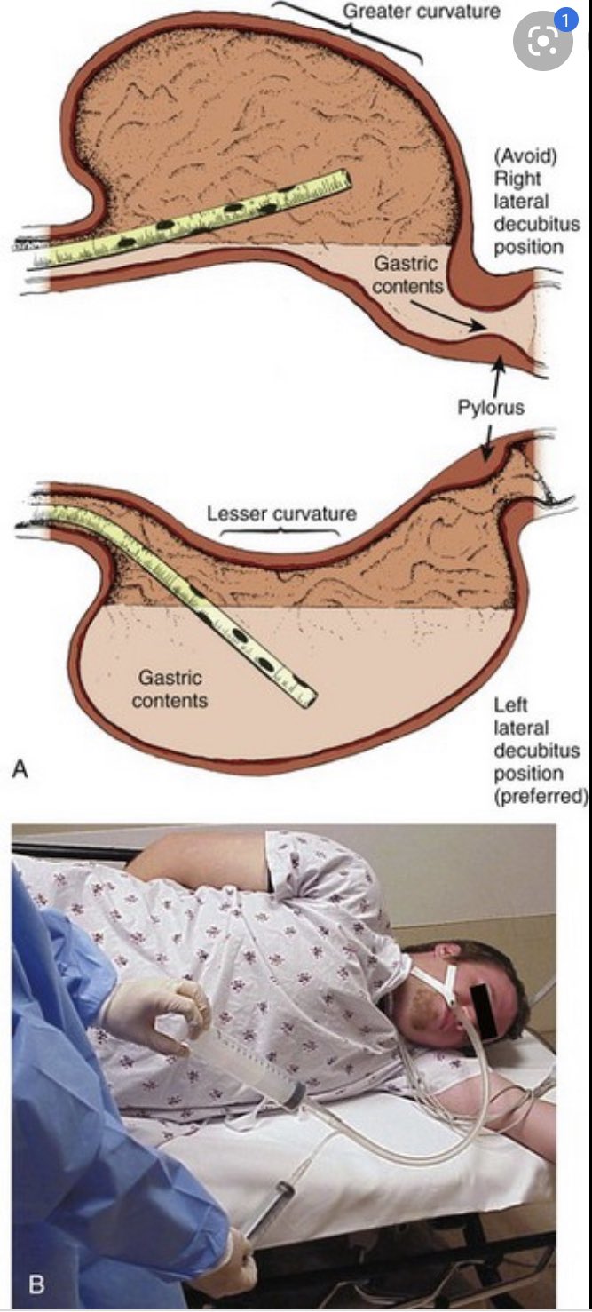 Left Lateral Decubitus Position