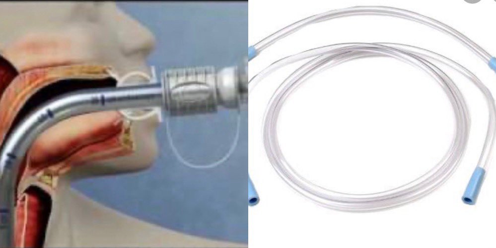 Let’s talk tricks for augmenting suction during endoscopy, as big clots ...