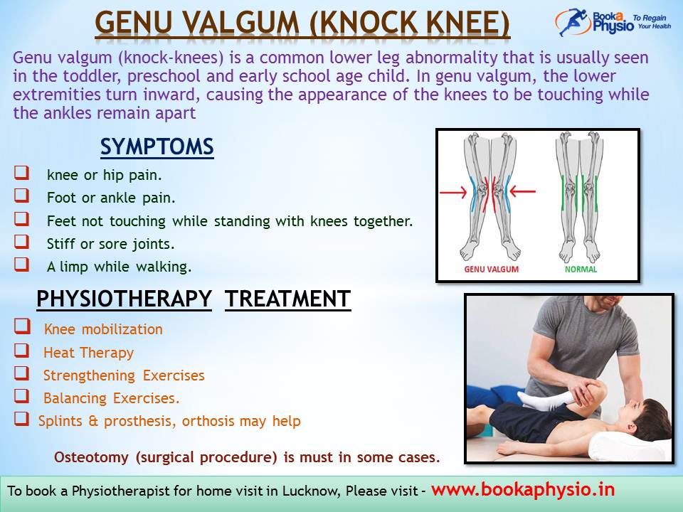 Genu Valgum Treatment