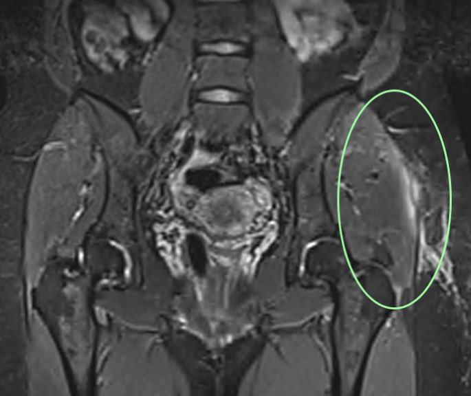 Pain Along Iliac Crest