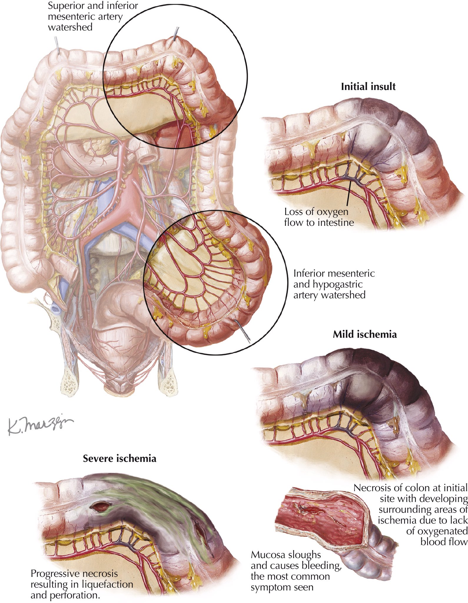 Splenic Flexure Watershed