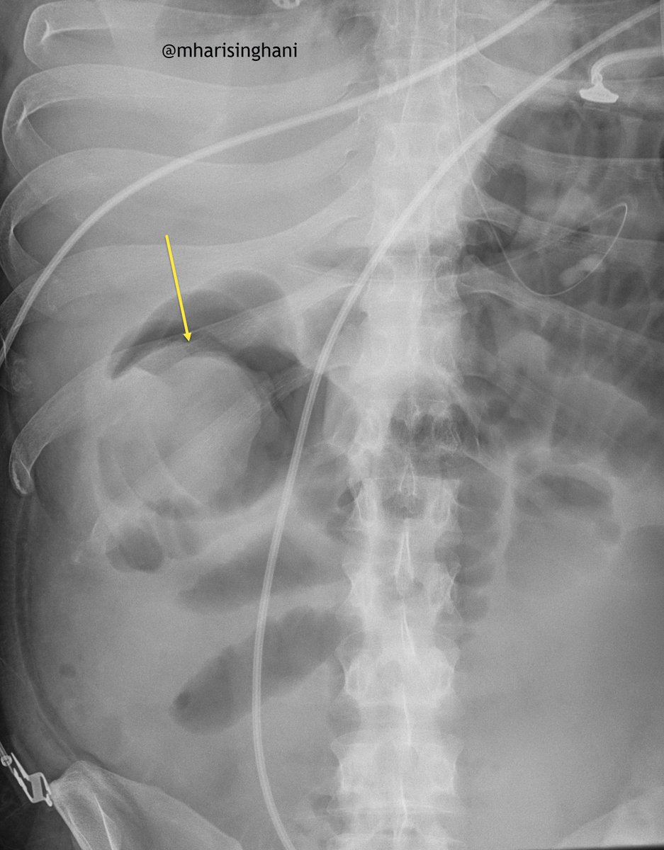Intussusception Claw Sign