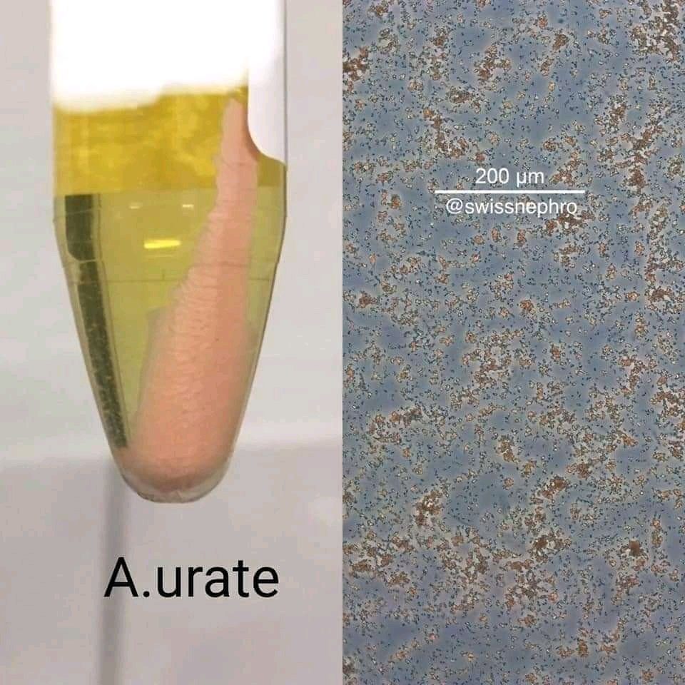 ما هو الفرق بين Amorphous urate Vs. Phosphate...?! سوف اتكلم عن بعض ...