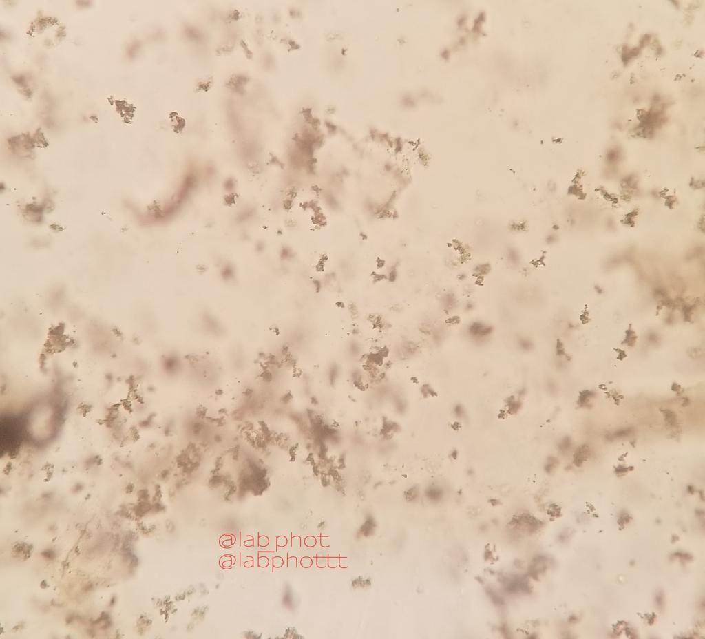 ما هو الفرق بين Amorphous urate Vs. Phosphate...?! سوف اتكلم عن بعض ...