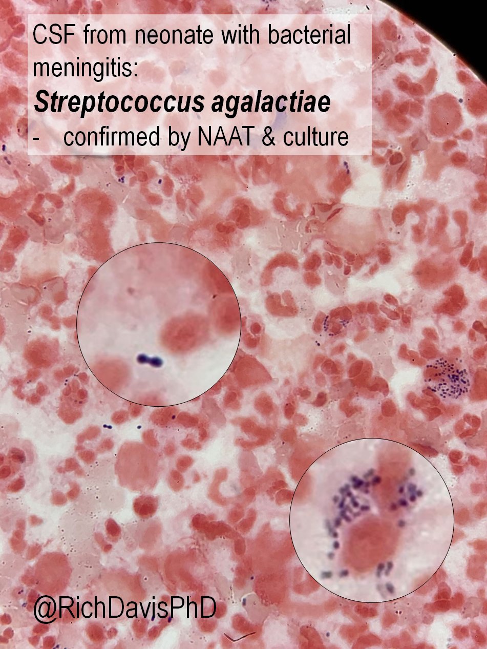 Streptococcus Agalactiae Gram Stain