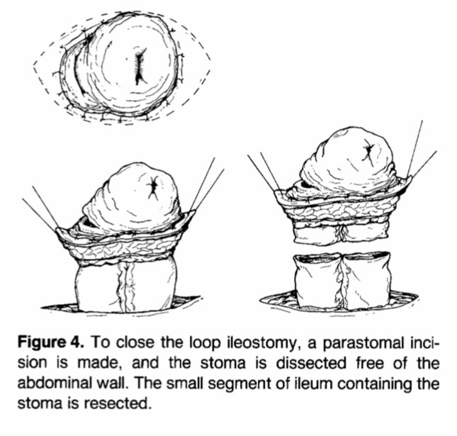 Loop Ileostomy Closure