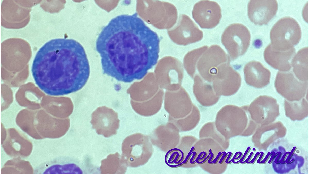 Plasmacytoid Lymphocytes