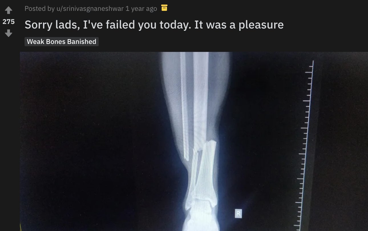 Broken Bone Memes 10 Funny Ideas | Funny, Broken Bone, Bones Funny