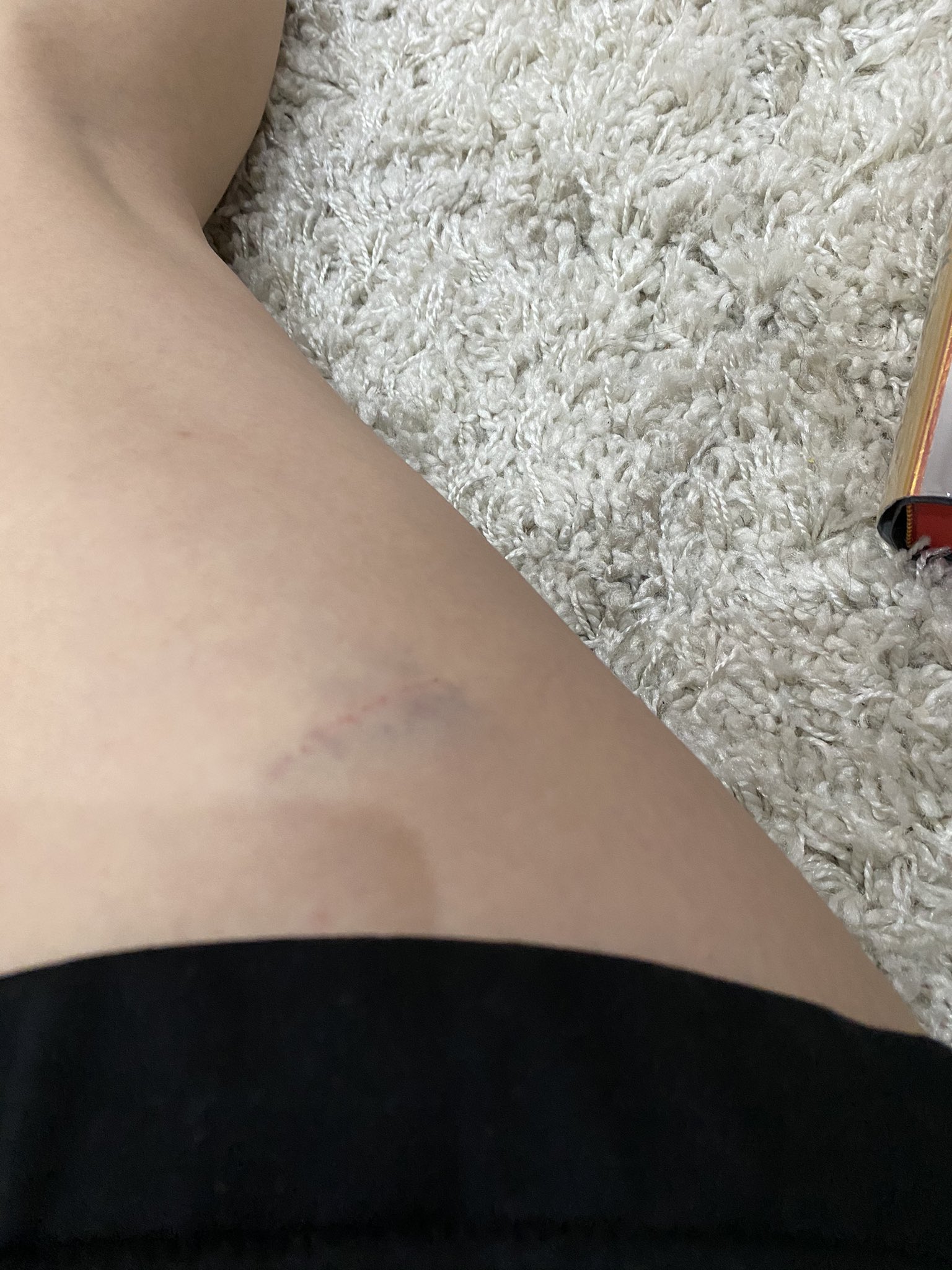 Anemic Bruise
