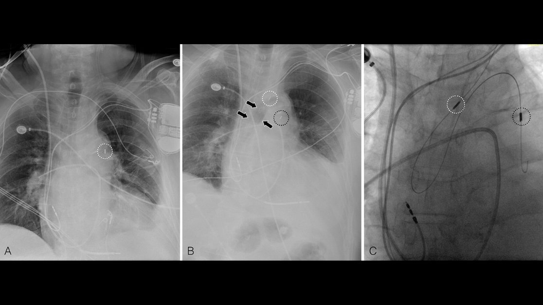 Intra Aortic Balloon Pump Xray