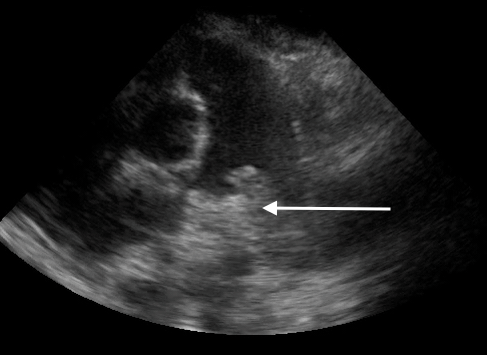 1/ Unexpected finding on #POCUS! (View of PA here, obtained by fanning ...