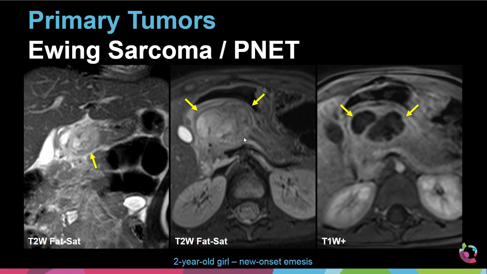 Ewing Sarcoma Mri