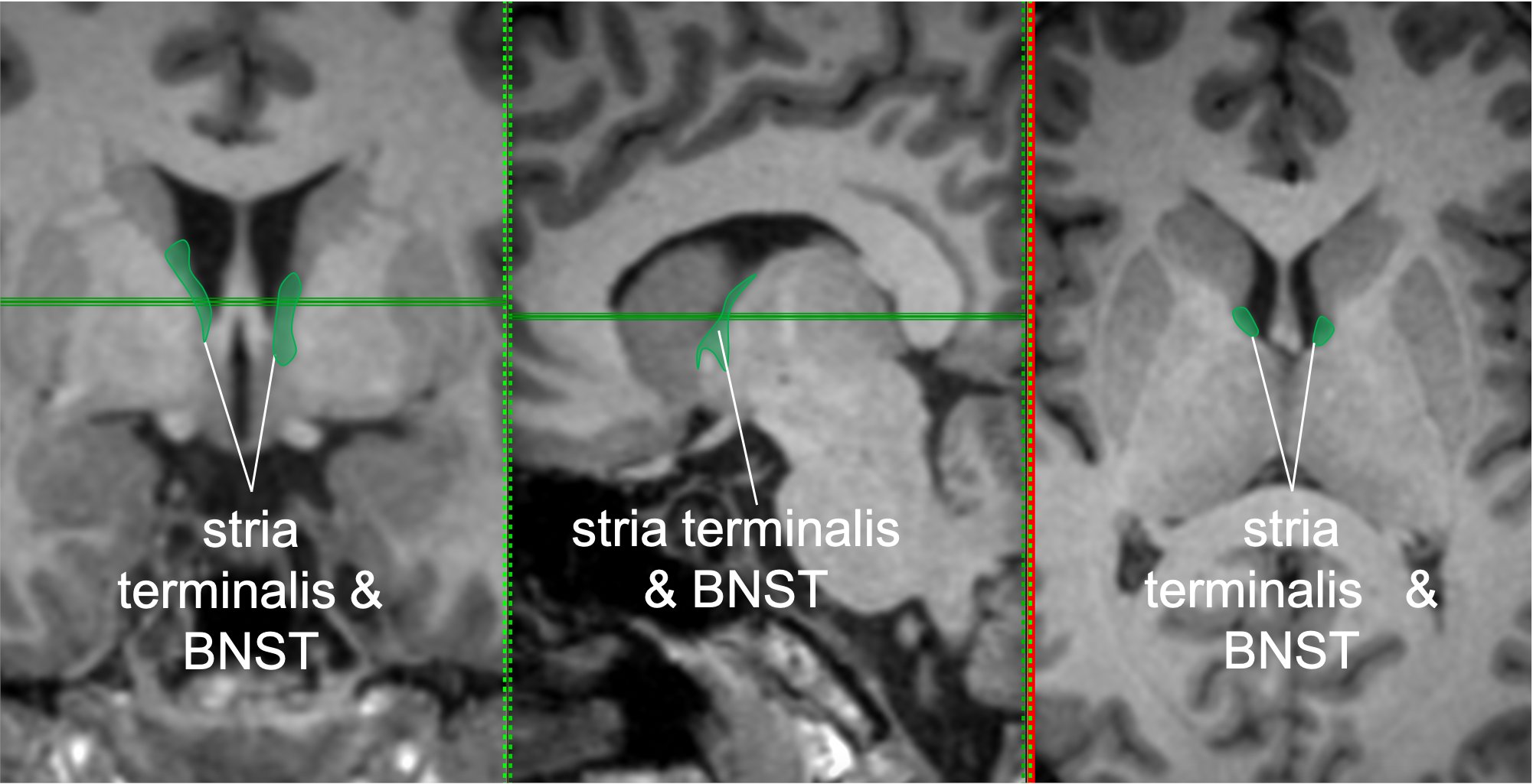 Nucleus Accumbens Mri