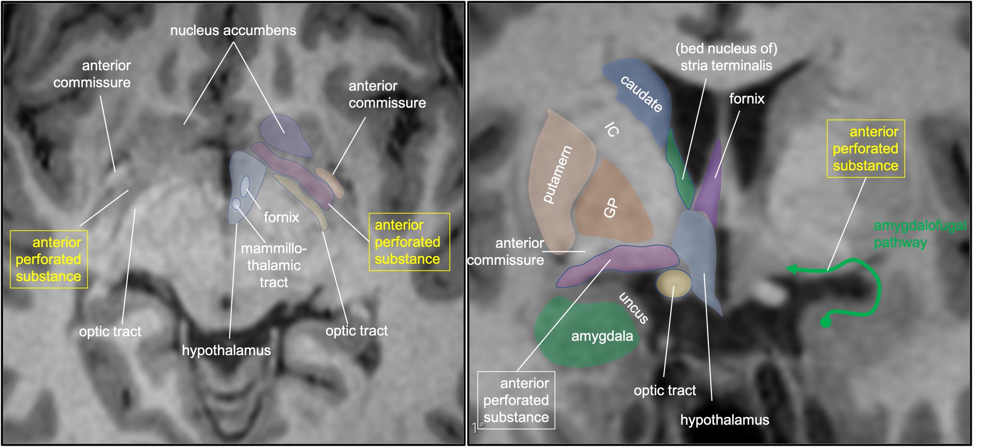 Posterior Perforated Substance