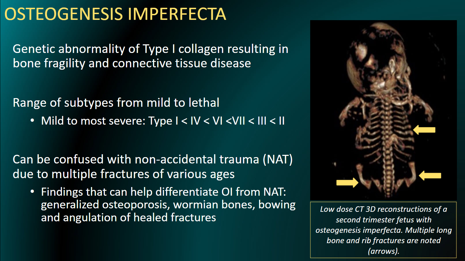 Osteogenesis Imperfecta Type Iv