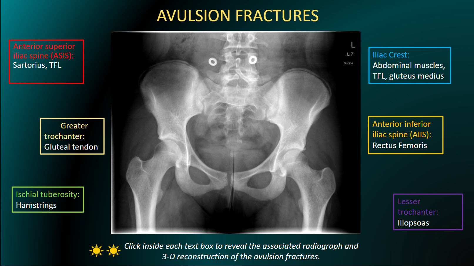 Anterior Superior Iliac Spine X Ray