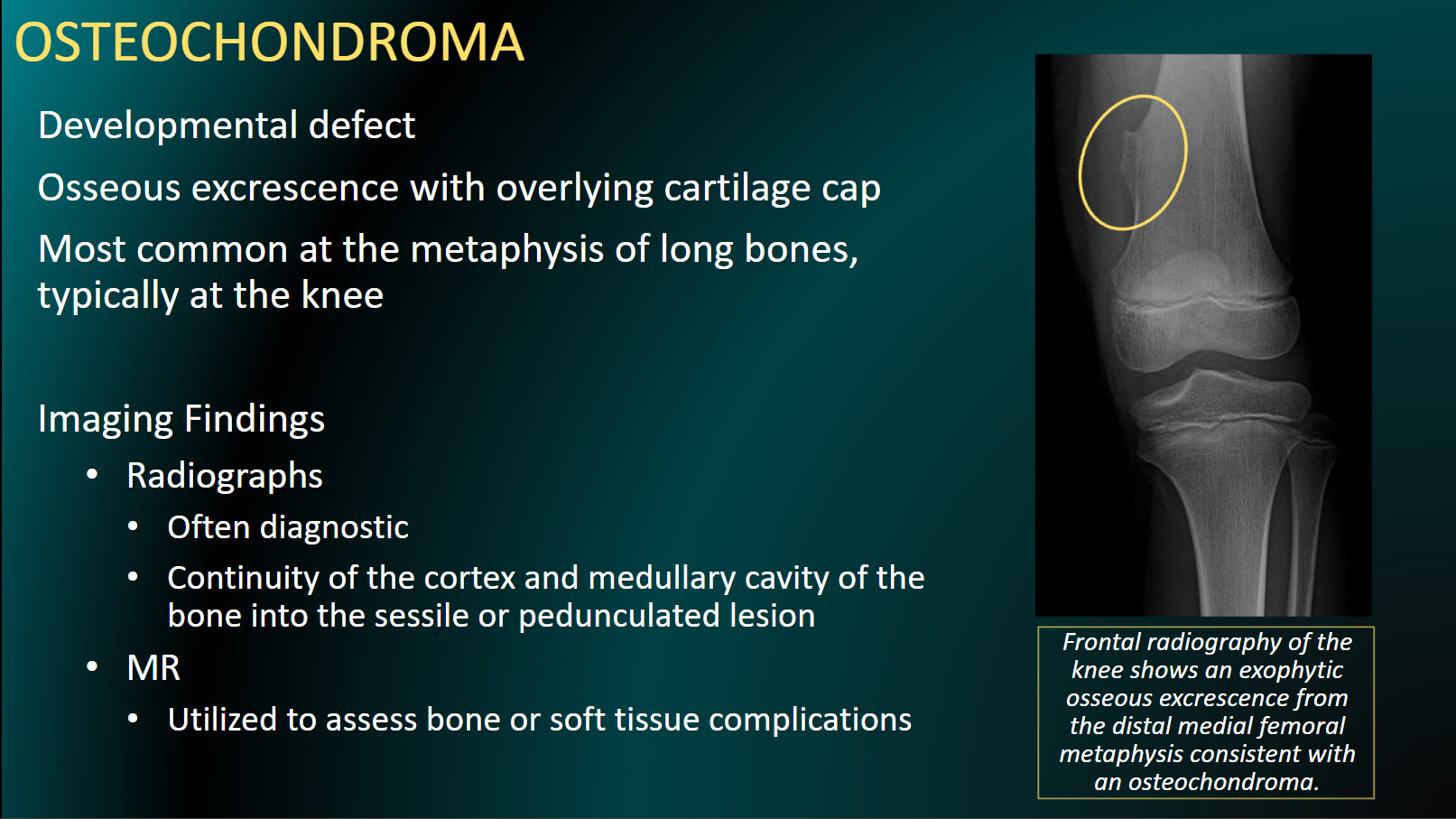 Osteochondroma