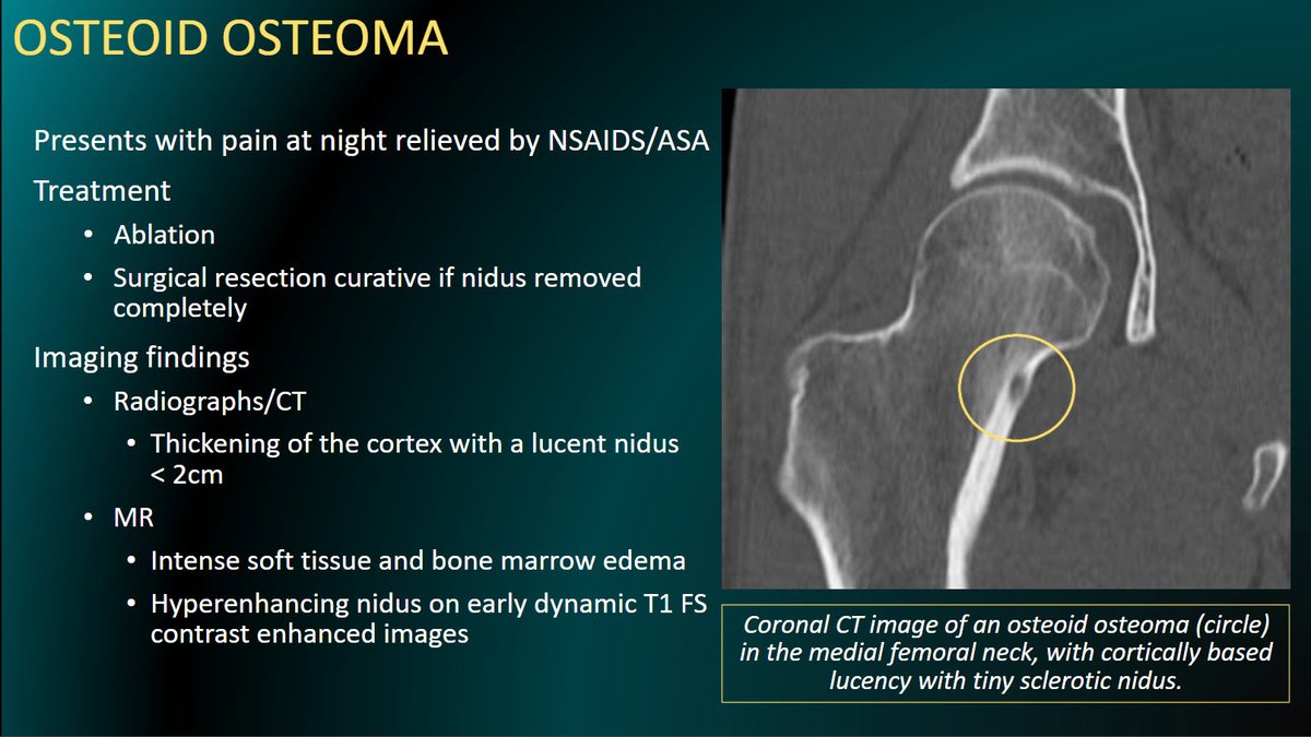 Osteoid Osteoma X Ray X Ray Of Osteoid Osteoma In Humerus Bone Of Arm