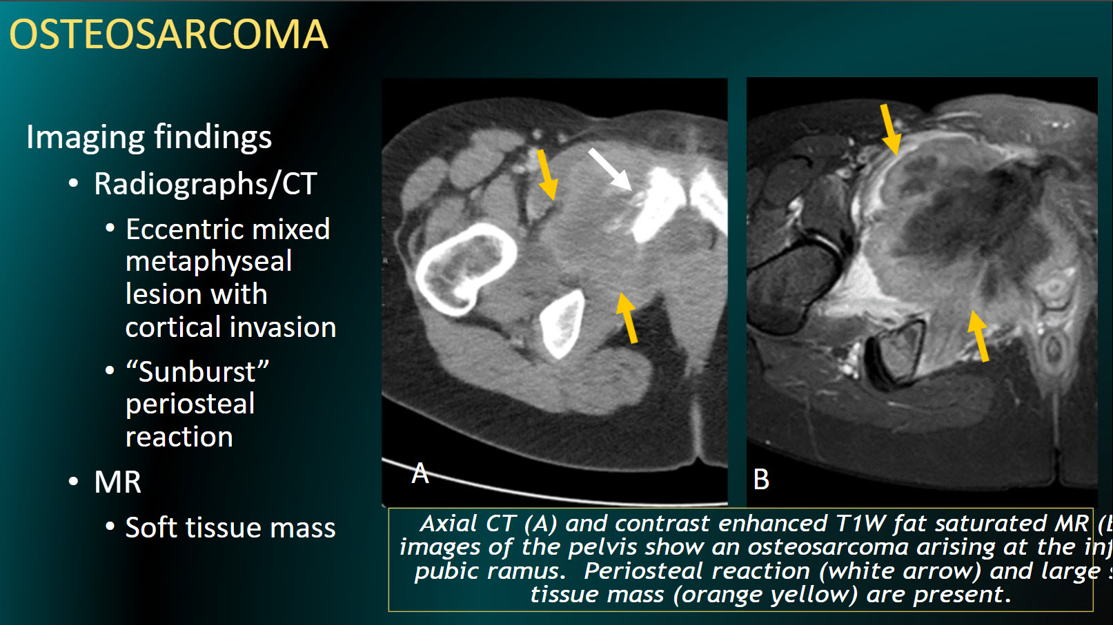 Osteosarcoma Sunburst