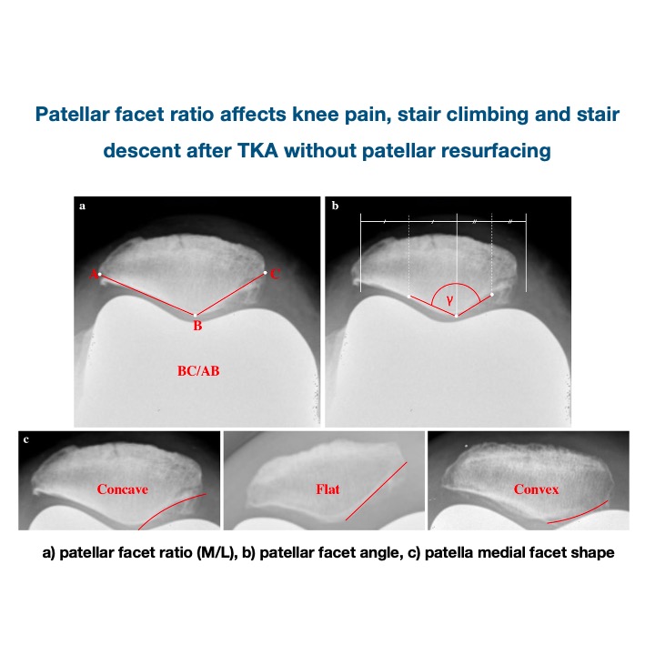 Patella Medial Facet