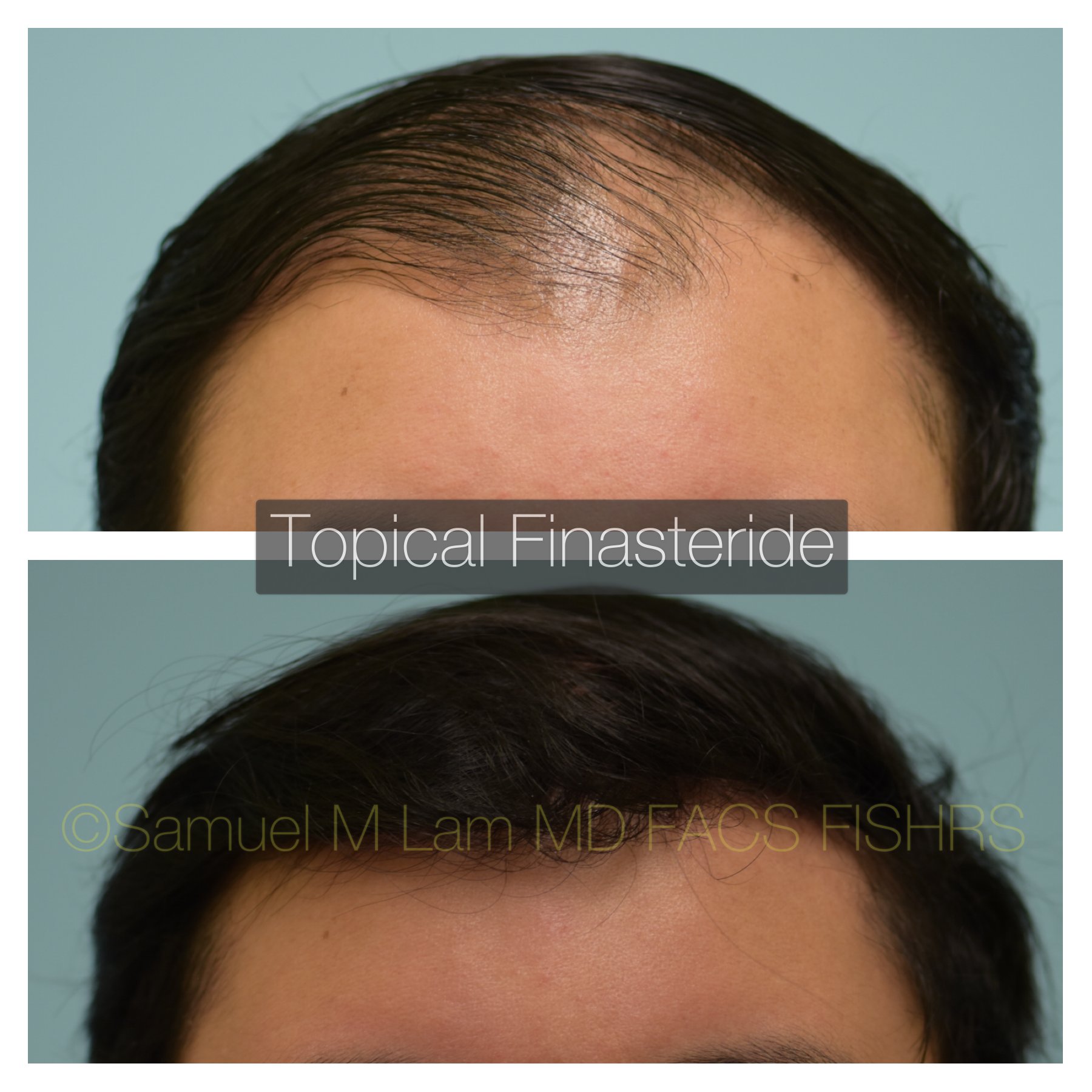 Finasteride Results 8 Months