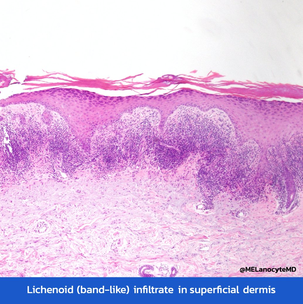 Lichen Planus Histology Sawtooth R J M E