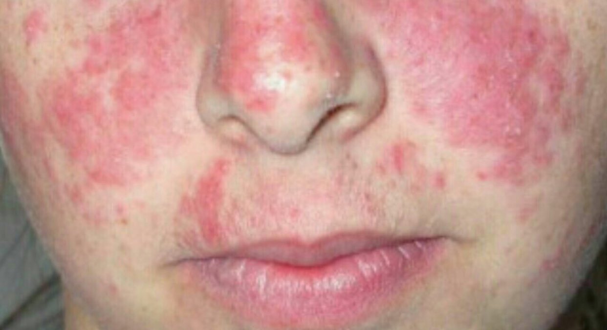 Lupus Rash