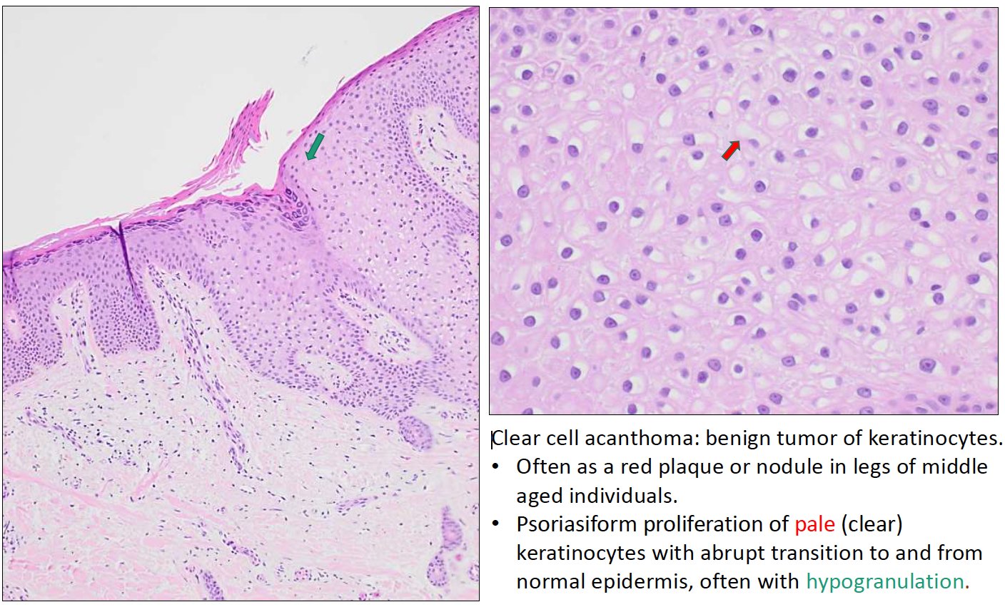 Clear Cell Acanthoma Histology