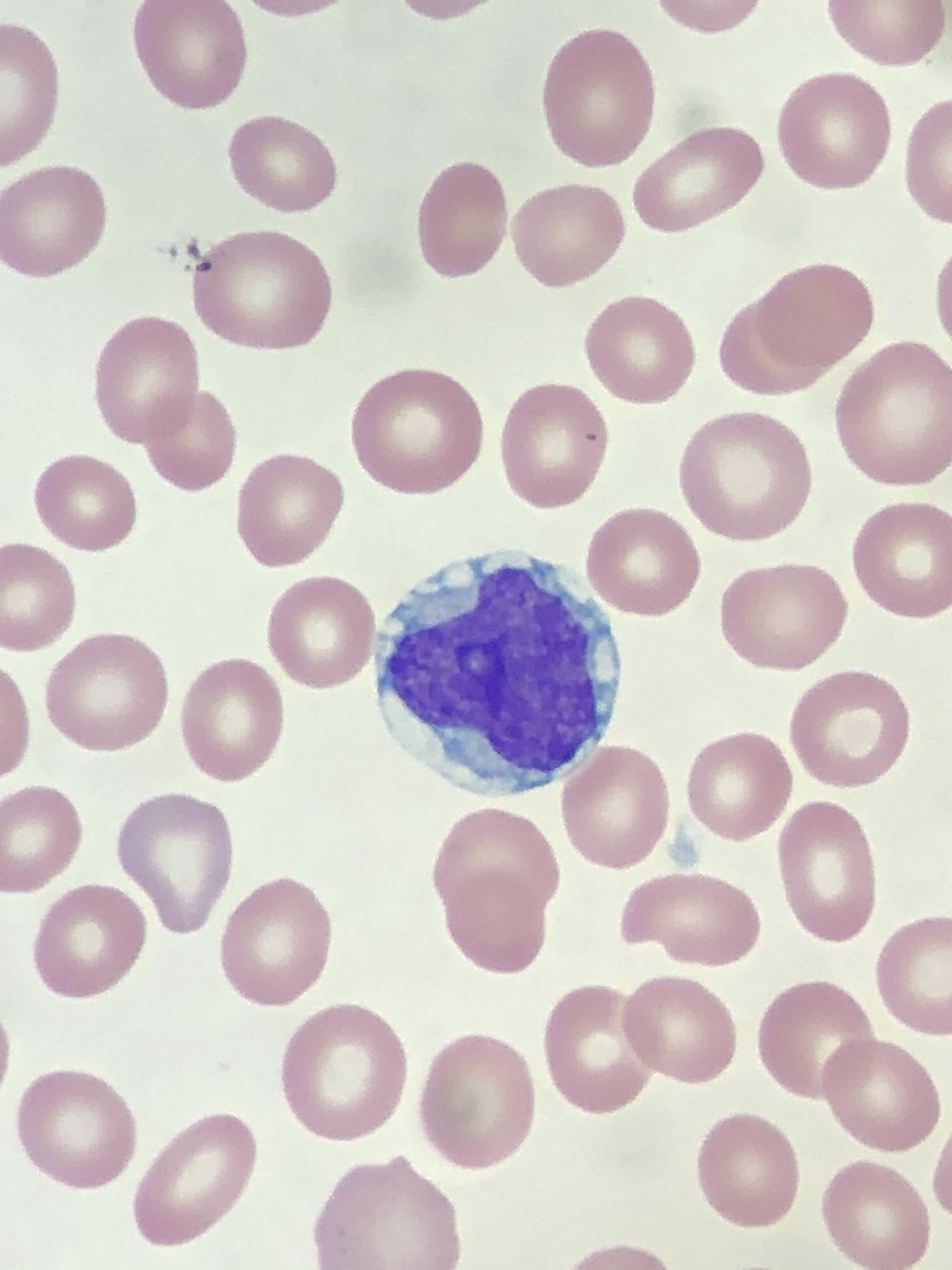 Cytoplasmic Vacuoles