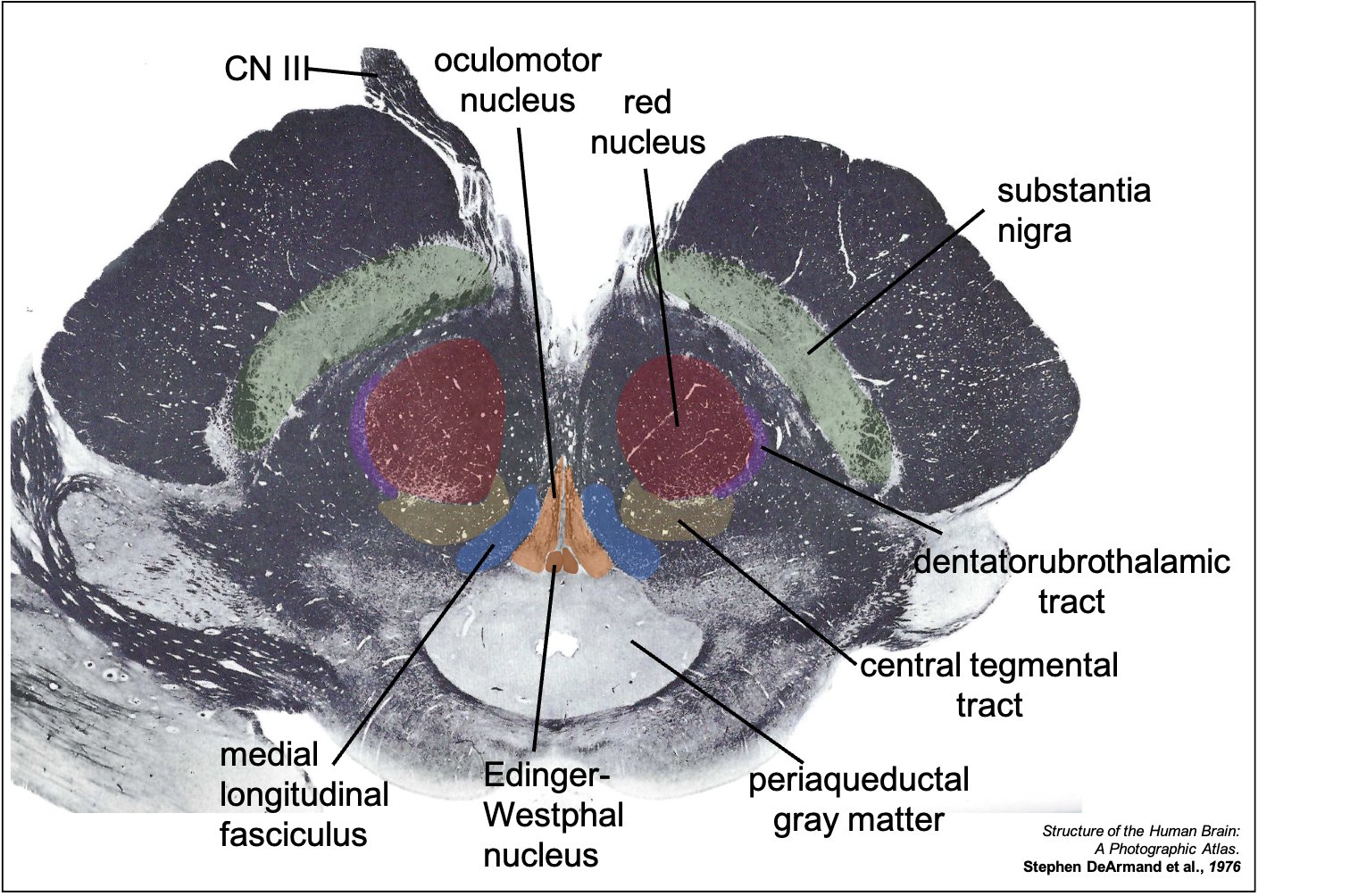 Red Nucleus And Substantia Nigra Tell Tail MRI Image Diagnosis For