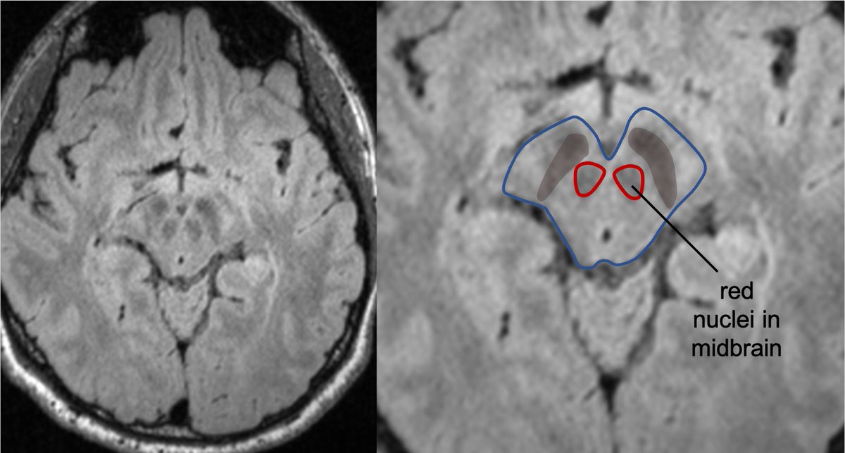 Substantia Nigra Red Nucleus