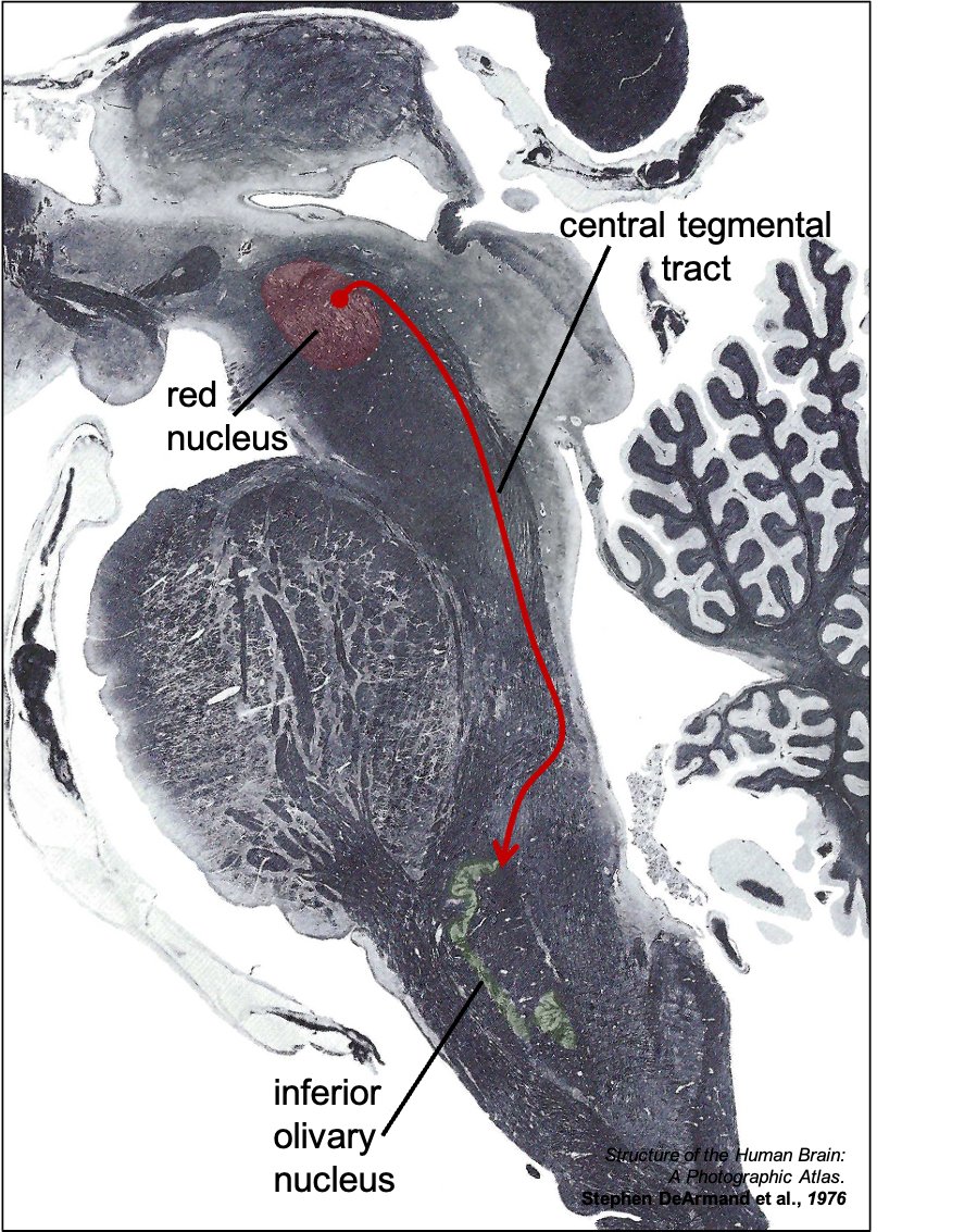 #NeuroanatomyTOTD #13🧵 Image1: hemosiderin due to old hemorrhage in the ...