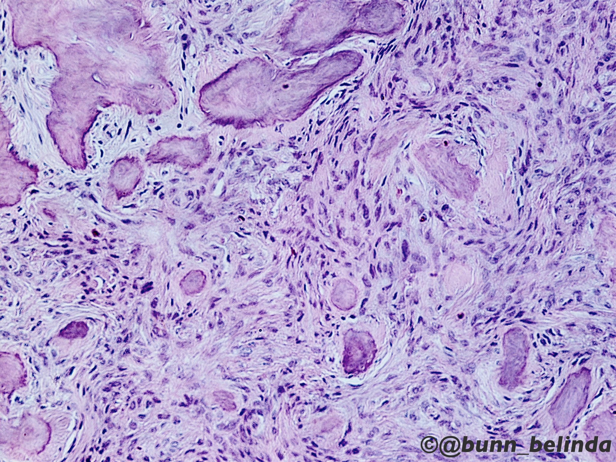 Ossifying Fibroma Histology
