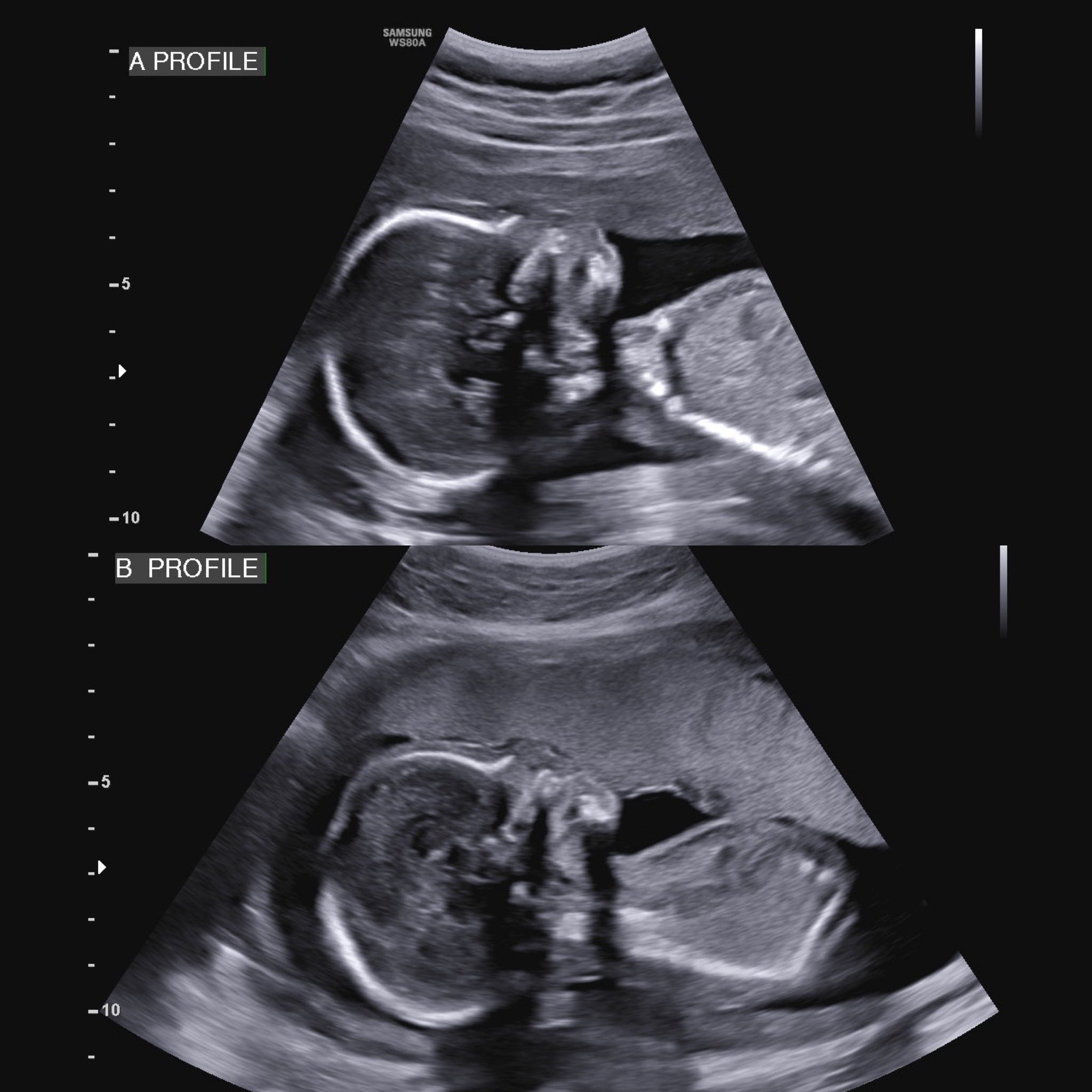 23 Weeks Ultrasound